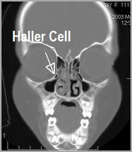 Medicine Decoded: Onodi cell & Haller cell
